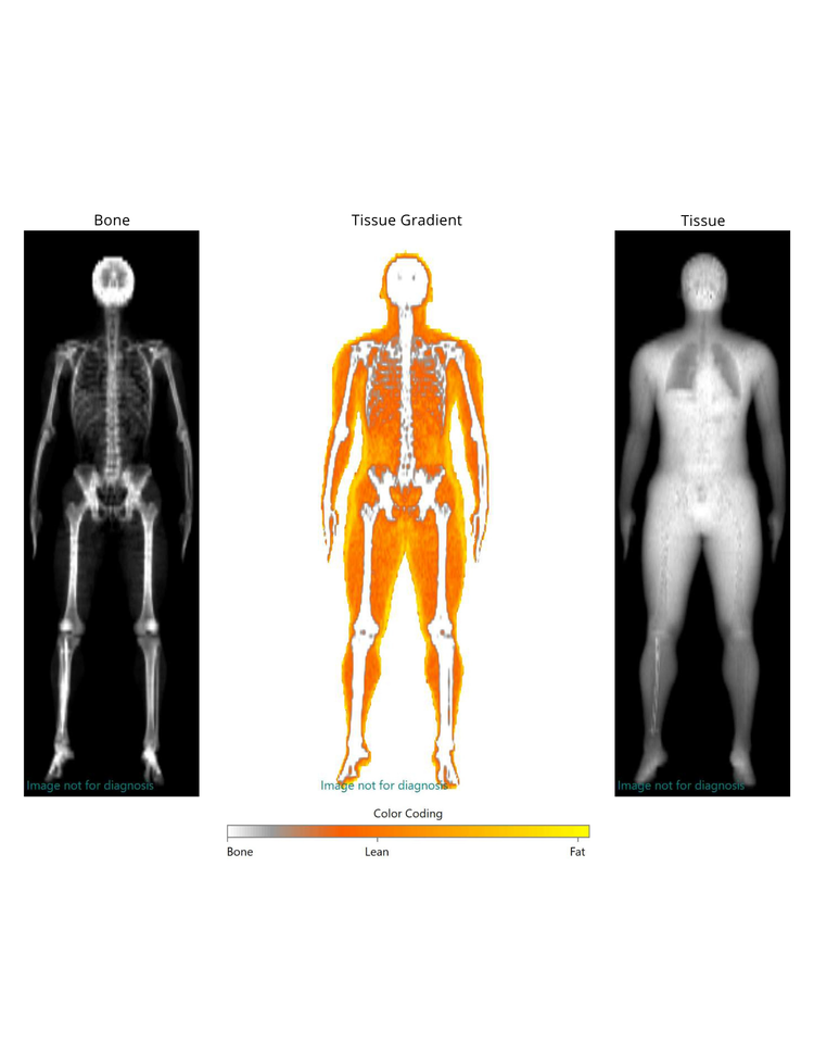 DEXA Health Vancouver - $30 DEXA Body Composition Scans