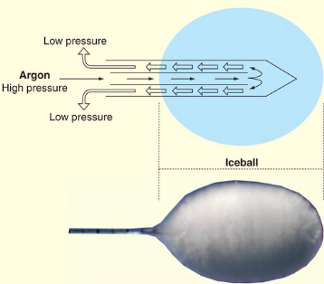 MRI Guided Cryoablation — Spectrum Interventional Radiology
