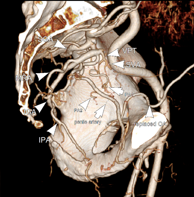 Prostate Artery Embolisation — Spectrum Interventional Radiology