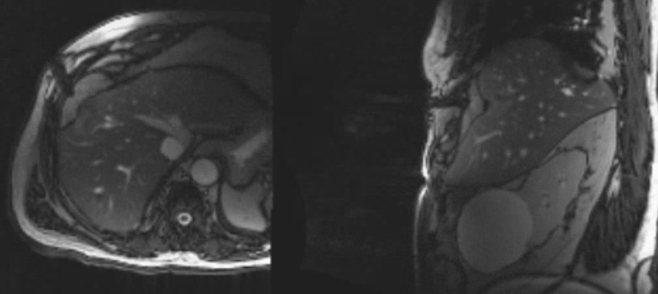 MRI Guided Cryoablation — Spectrum Interventional Radiology