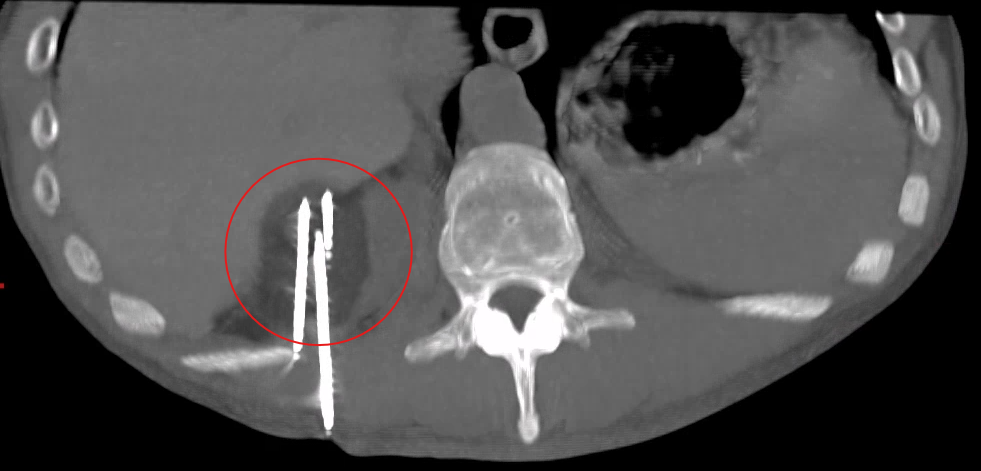 MRI Guided Cryoablation — Spectrum Interventional Radiology