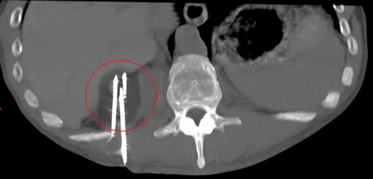 MRI Guided Cryoablation — Spectrum Interventional Radiology