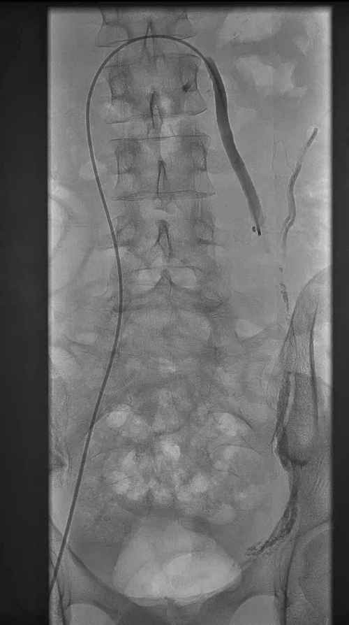 Varicocele Embolisation | Discover Fast, Effective Treatment Today ...