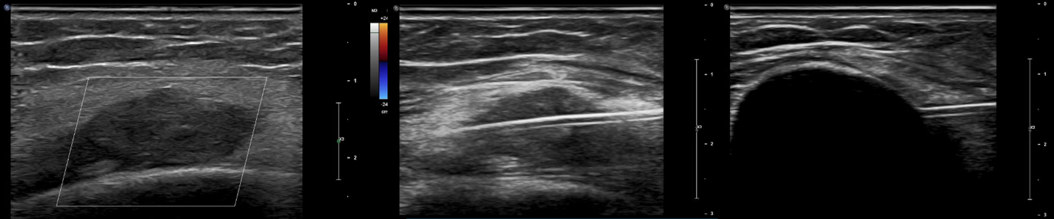 MRI Guided Cryoablation — Spectrum Interventional Radiology