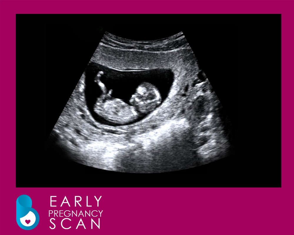 Baby Scan Leeds - All Scans For £39 Only