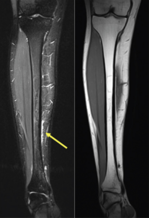 Do I Have Shin Splints? Understanding Medial Tibial Stress Syndrome and ...
