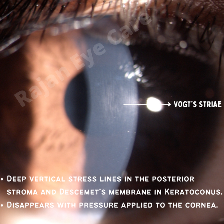 Vogt’s Striae - Keratoconus — Ophthalmobytes