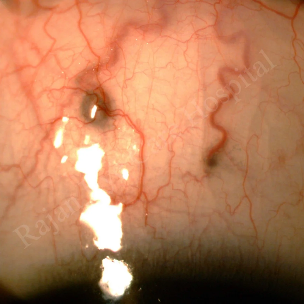 Looping Nerves! — Ophthalmobytes
