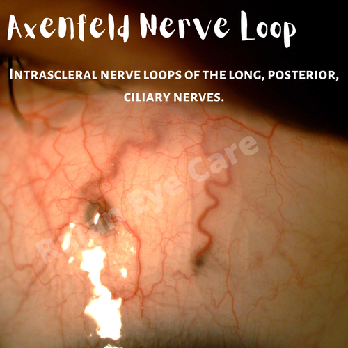 Axenfeld Nerve Loop — Ophthalmobytes