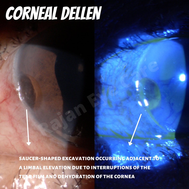 Corneal Dellen — Ophthalmobytes