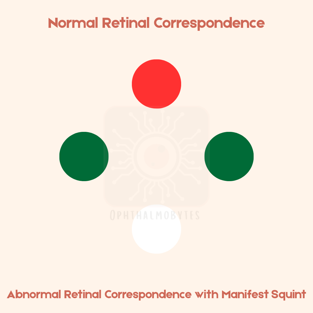 Worth 4 dot Test — Ophthalmobytes