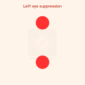 Worth 4 dot Test — Ophthalmobytes