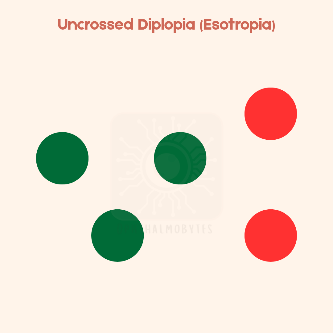 Worth 4 dot Test — Ophthalmobytes
