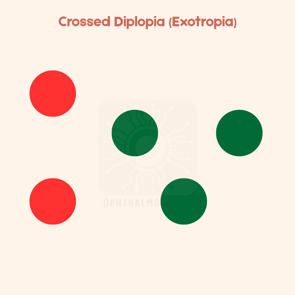 Worth 4 dot Test — Ophthalmobytes