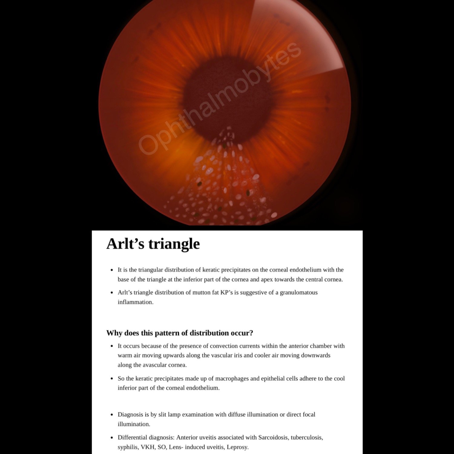 Arlt’s Triangle — Ophthalmobytes