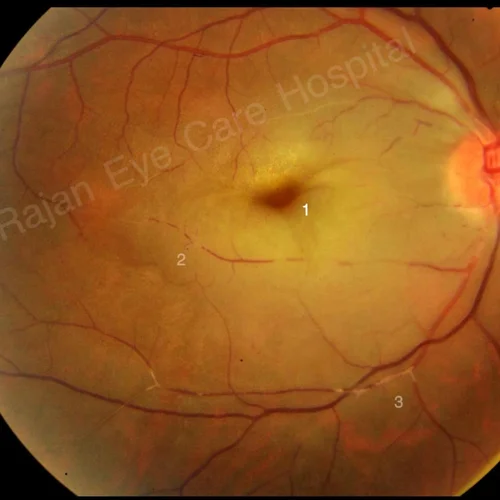 Stroke in the eye! - CRAO — Ophthalmobytes