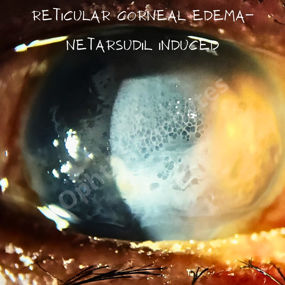 Netarsudil-induced corneal edema — Ophthalmobytes