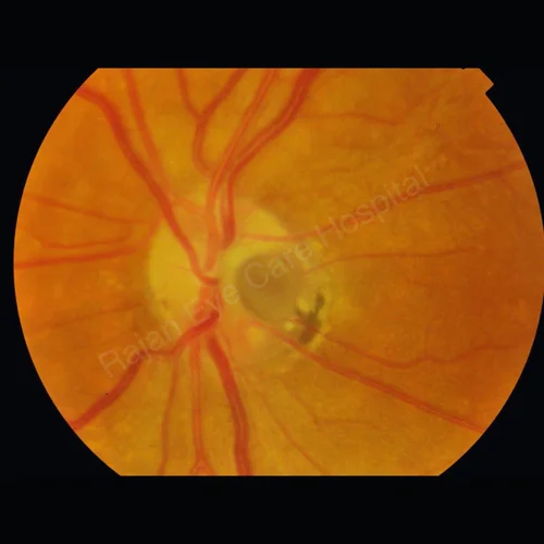 Pitted Disc — Ophthalmobytes