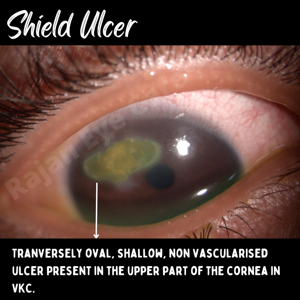 Shield Ulcer in VKC — Ophthalmobytes
