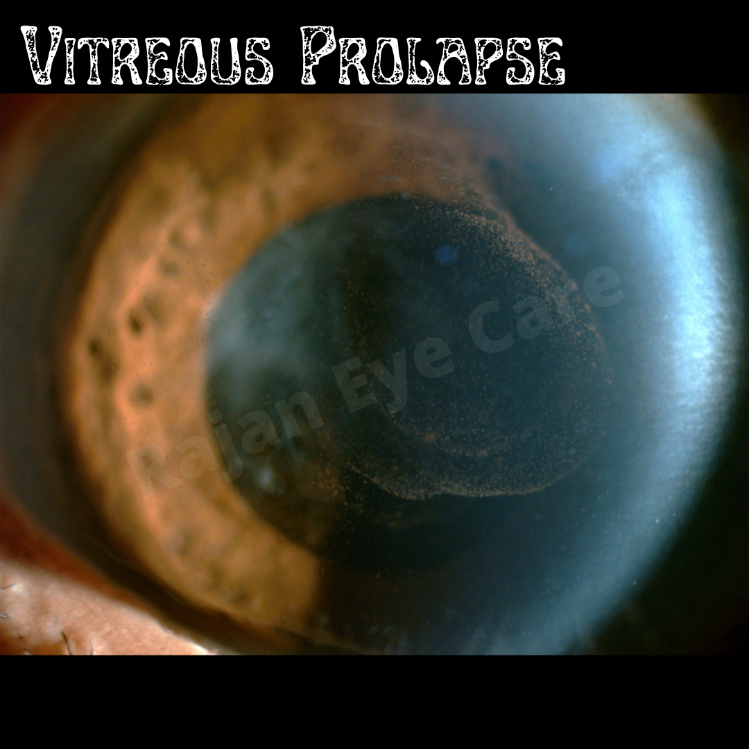 Vitreous Prolapse — Ophthalmobytes