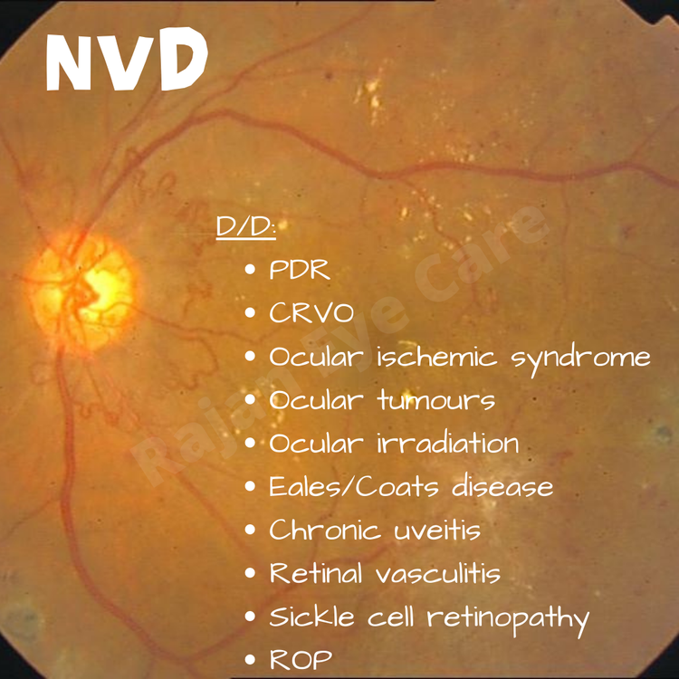 Neovascularisation of Disc - Differential Diagnosis — Ophthalmobytes