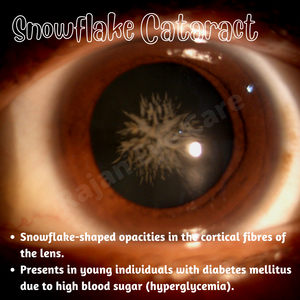 Snowflake Cataract — Ophthalmobytes