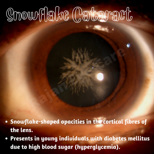 Snowflake Cataract — Ophthalmobytes
