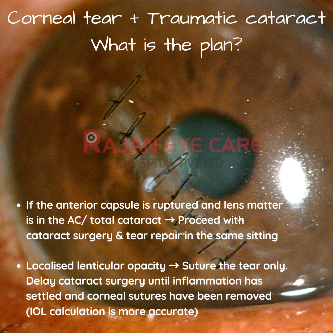 Corneal tear with traumatic cataract — Ophthalmobytes