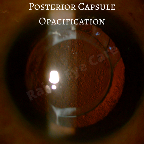 Posterior Capsule Opacification — Ophthalmobytes