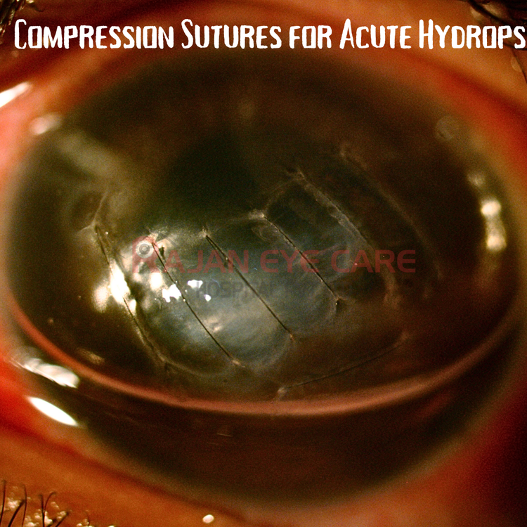 Compression sutures — Ophthalmobytes