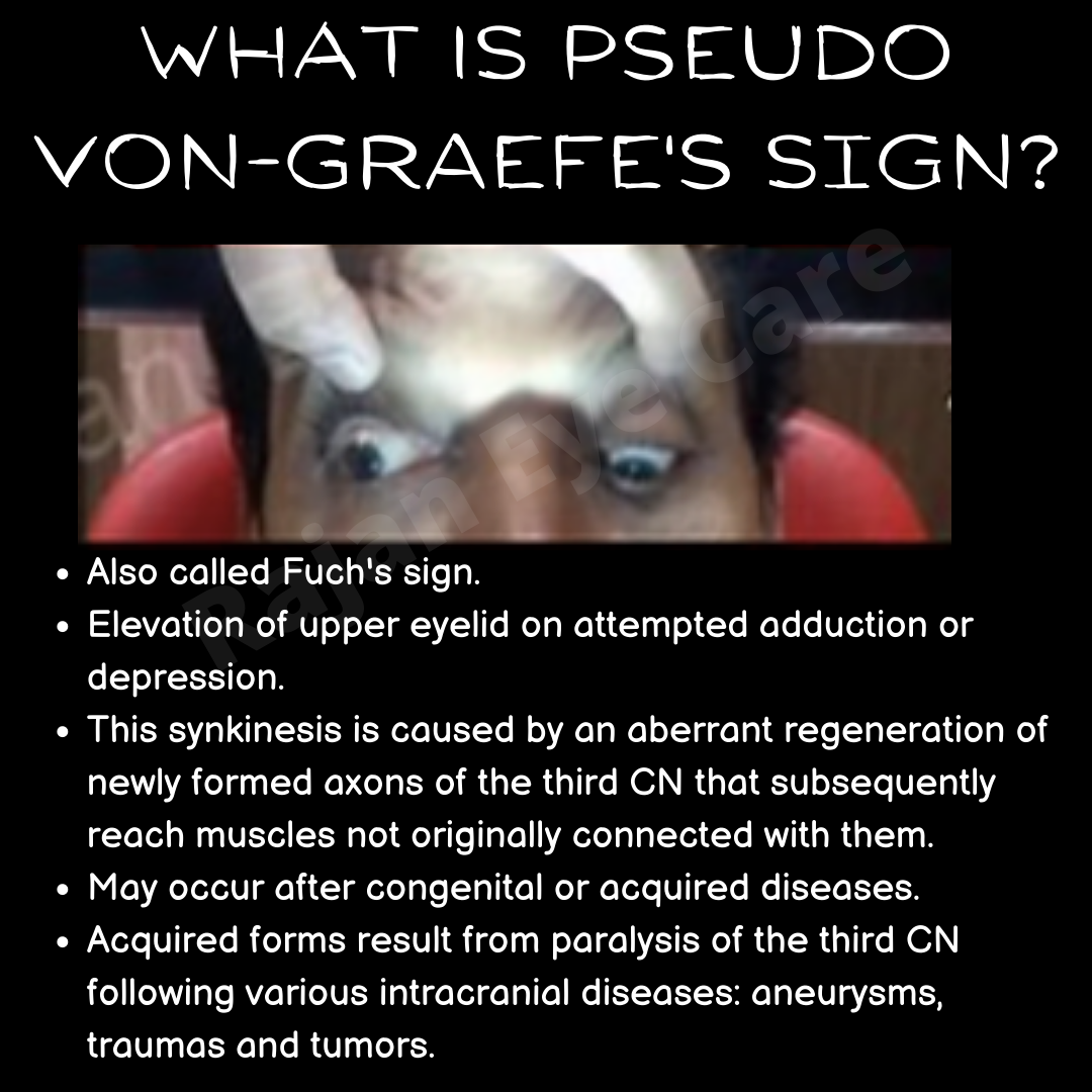 What is Pseudo Von-Graefe’s Sign? — Ophthalmobytes