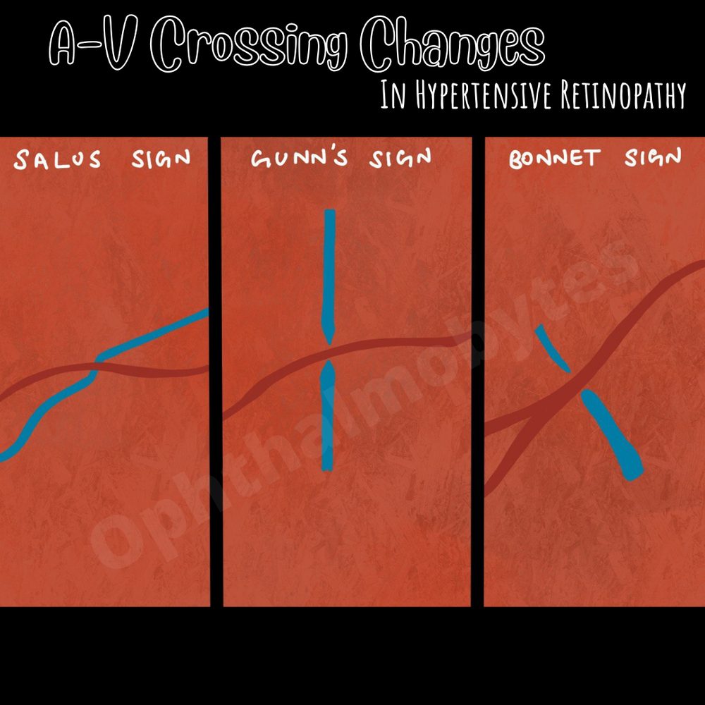 Arterio-venous changes in Hypertensive Retinopathy — Ophthalmobytes
