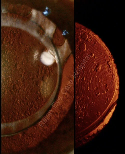 Finding Pearls! — Ophthalmobytes