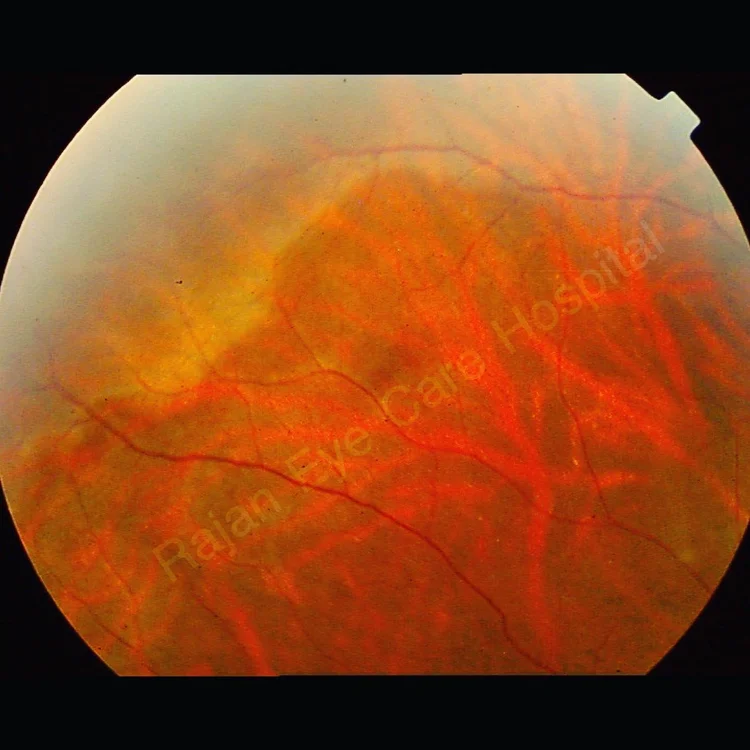 White Retina — Ophthalmobytes