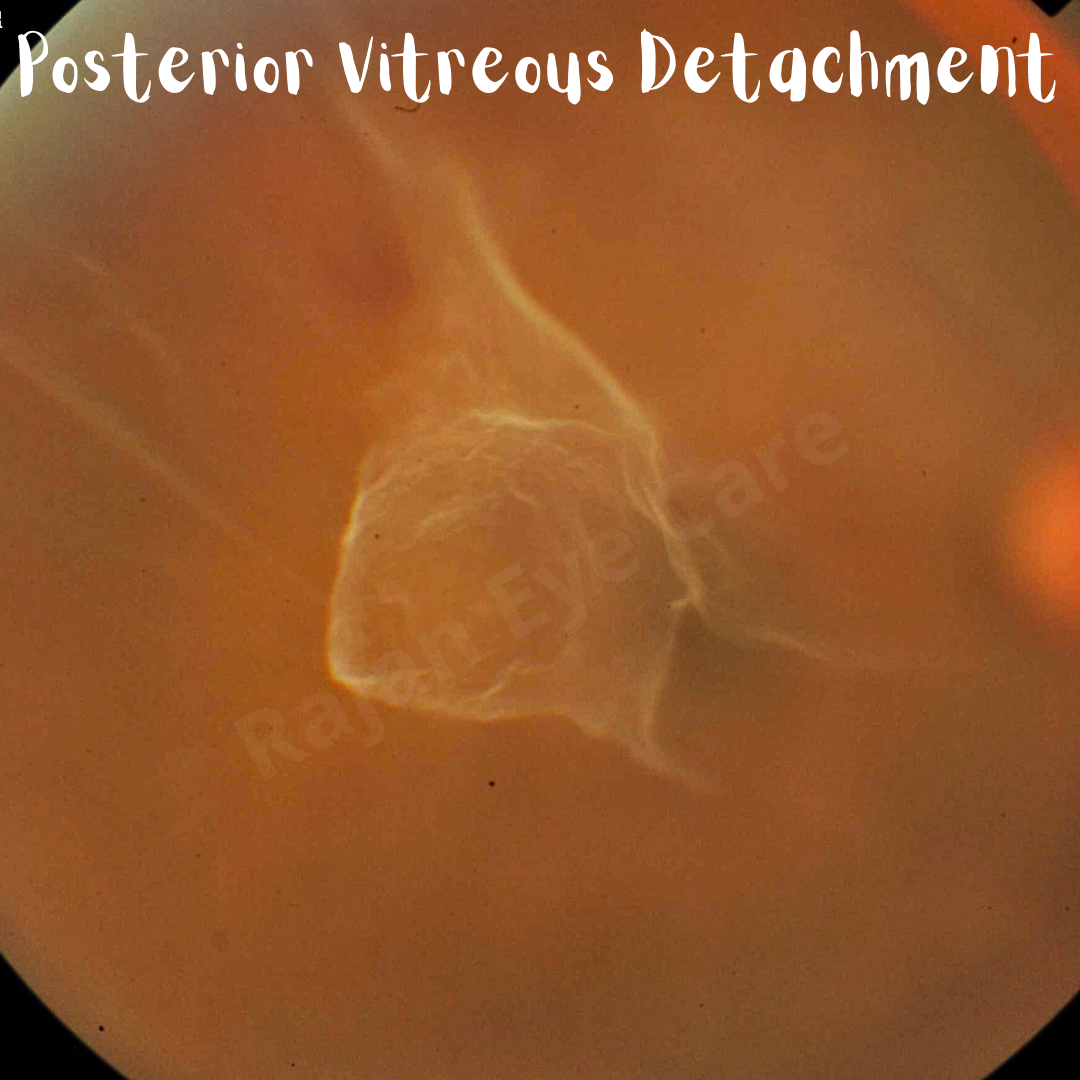 Posterior Vitreous Detachment — Ophthalmobytes