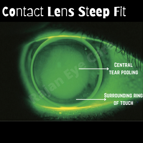 Steep fit of Contact Lens — Ophthalmobytes