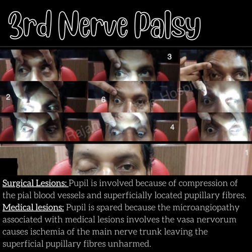 Pupil Involvement in 3rd nerve palsy — Ophthalmobytes