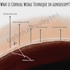 What is Corneal Wedge technique in Gonioscopy? — Ophthalmobytes