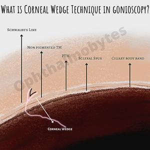 What is Corneal Wedge technique in Gonioscopy? — Ophthalmobytes