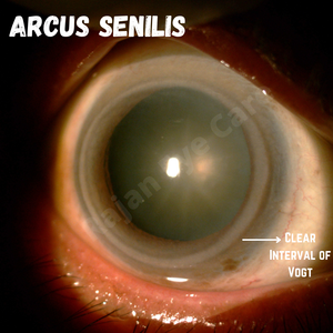 Arcus Senilis — Ophthalmobytes