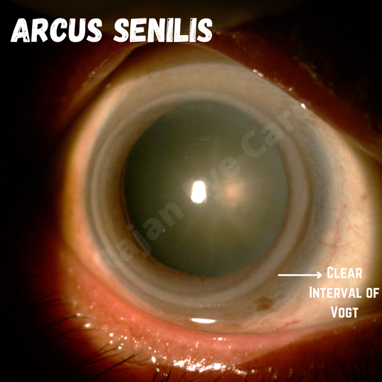 Arcus Senilis — Ophthalmobytes