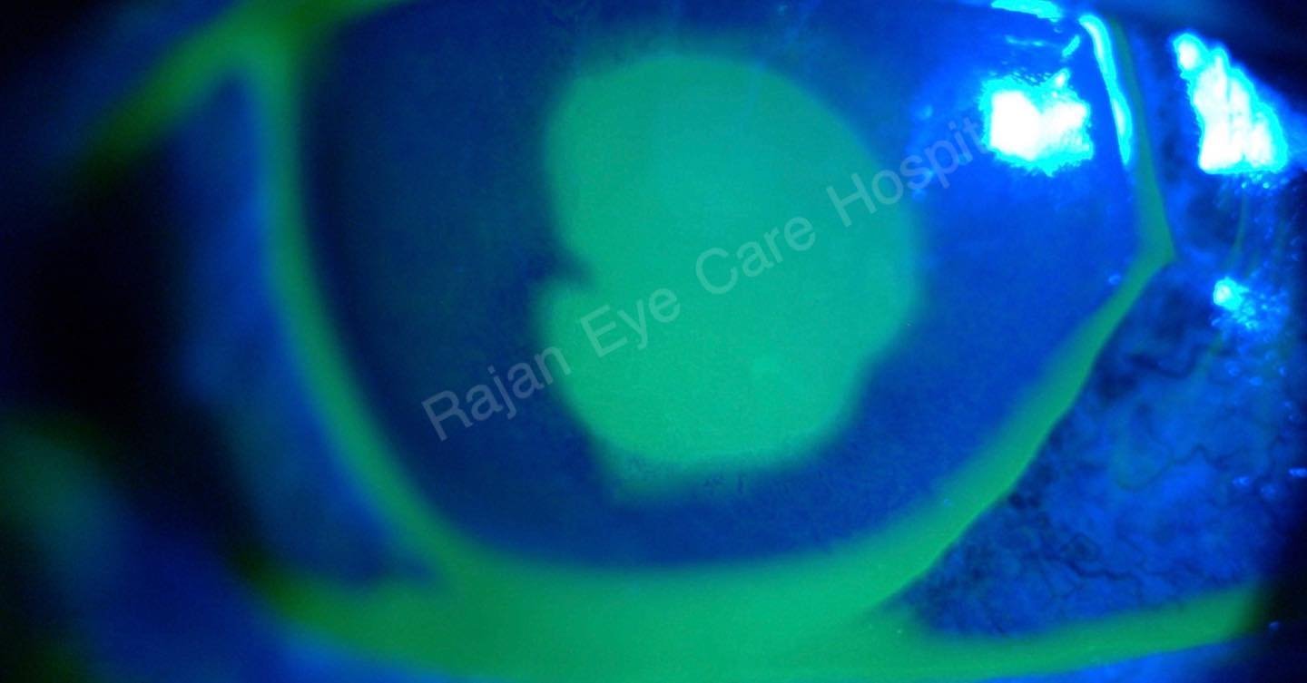 Scratches in the eye — Ophthalmobytes