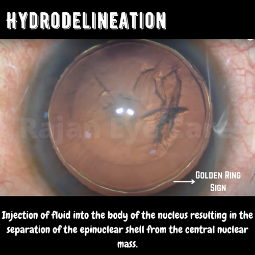 Golden Ring Sign - Hydrodelineation — Ophthalmobytes