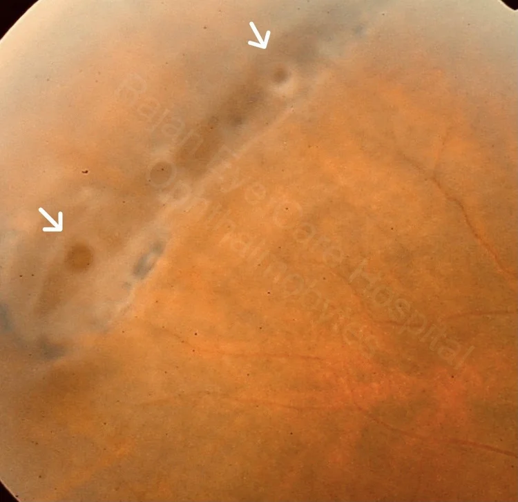 (Atrophic) Hole in the Retina — Ophthalmobytes