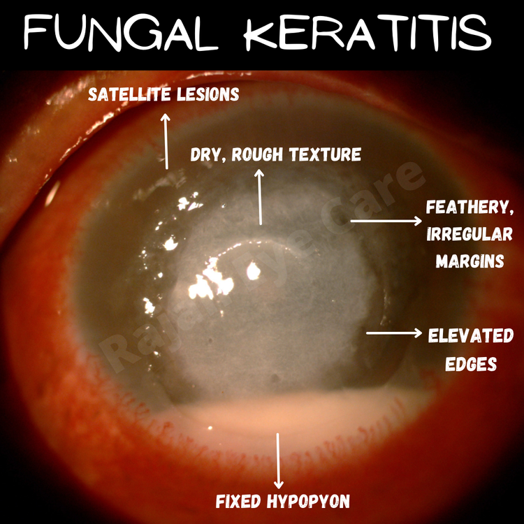 An overview of Fungal Keratitis — Ophthalmobytes