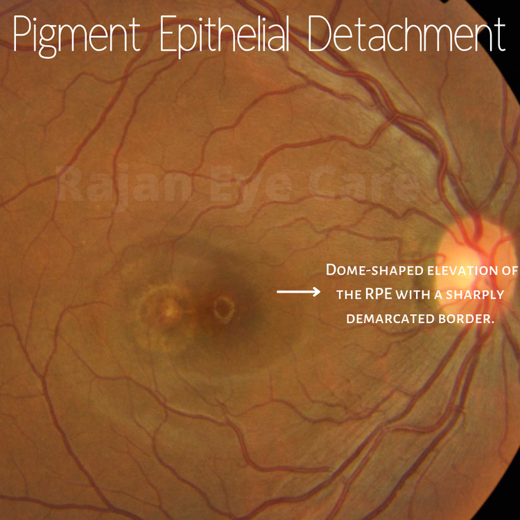 Serous Pigment Epithelial Detachment — Ophthalmobytes