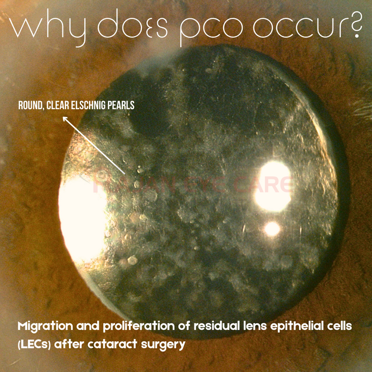 Why does PCO occur? — Ophthalmobytes