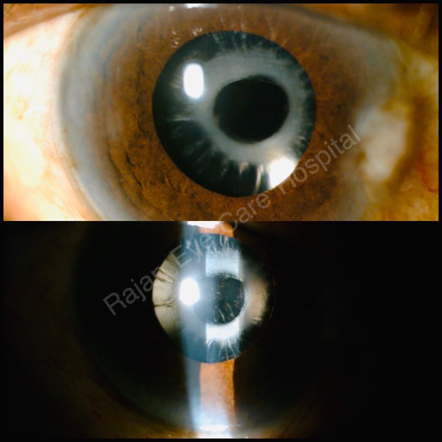 Capsular Phimosis Syndrome — Ophthalmobytes