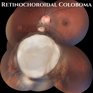 Retinochoroidal Coloboma — Ophthalmobytes