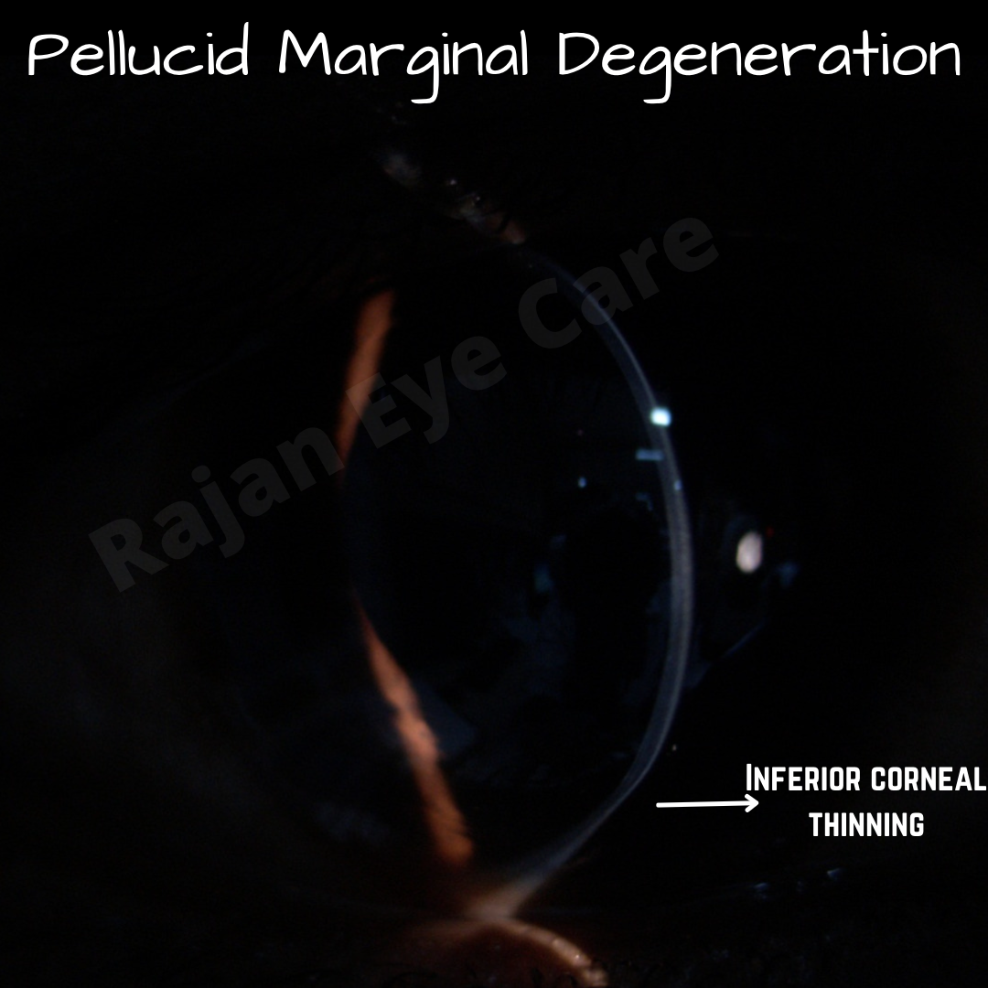 Pellucid Marginal Degeneration — Ophthalmobytes